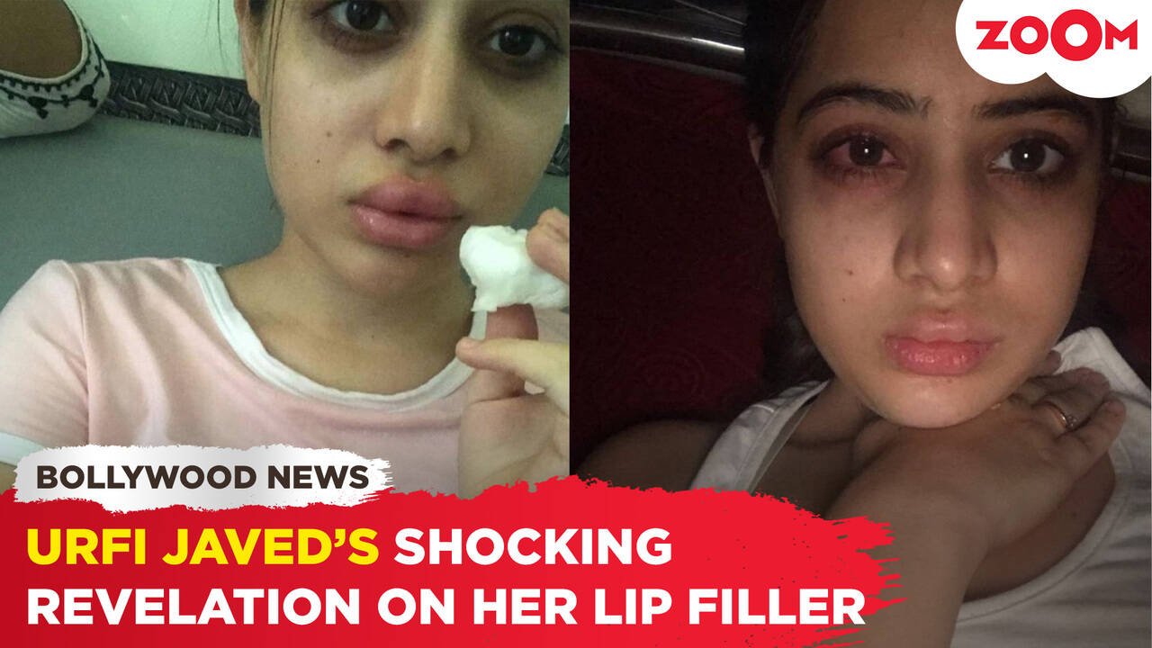 Urfi Javed REVEALS doing lip fillers since she was 18 says, ‘instead of ...