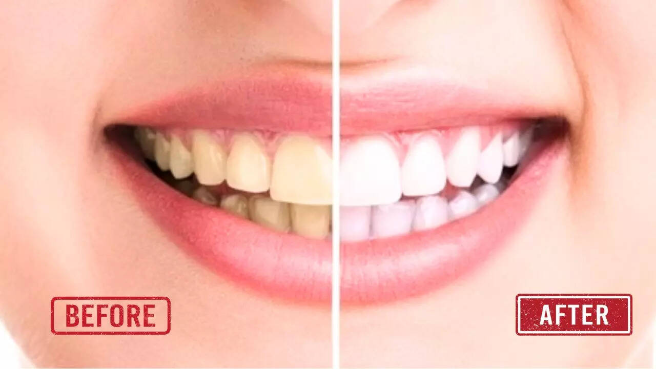 Good Bye To Yellow Teeth: पीले दांतों को दो दिन में करें सफेद-Whiten ...