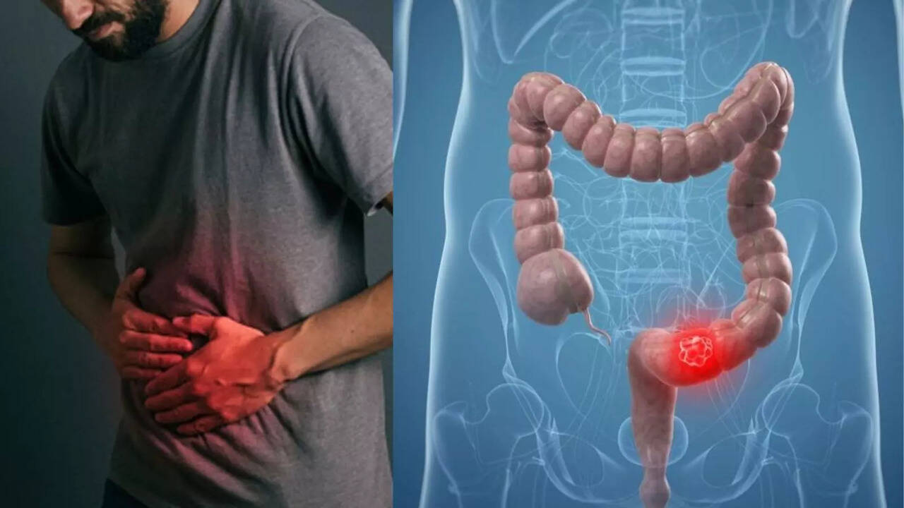 What Is Colon Cancer? All You Need To Know About Its Symptoms, Causes ...