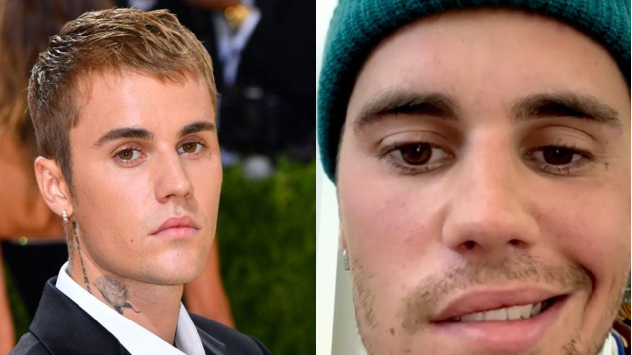 Justin Bieber shares update after facial paralysis diagnosis; says ‘I ...